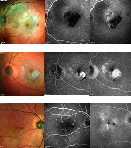 Recherche sur la dégénérescence maculaire liée à l’âge (DMLA) (Pr ...